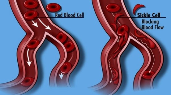 Sickle Cell Disease: Information for Parents – Pathway Pediatric