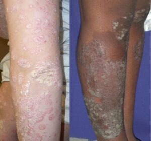 Psoriasis in Children & Teens: Symptoms, Causes, & Treatment – Pathway ...